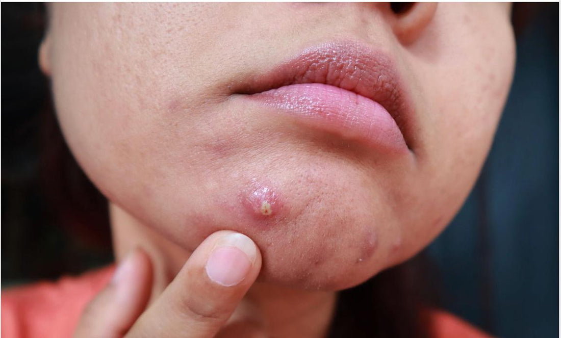 Zits on Chin: Causes, Types, Fast Relief, and Long-Term Fixes (With Sa ...
