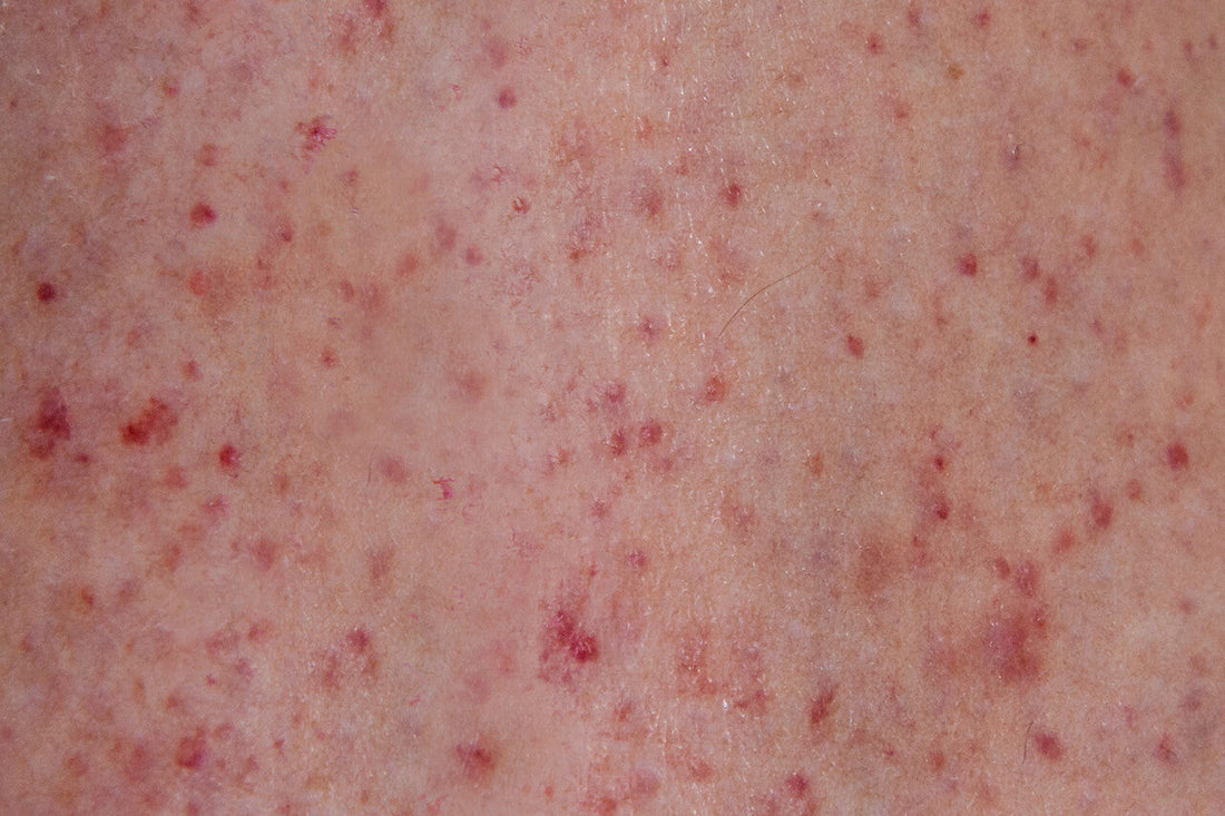 Red Spots on Skin: Causes, Treatments, and Skincare Insights – The Element